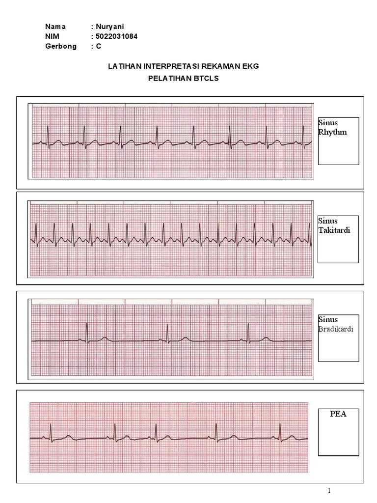Interpretasi EKG PEA dan Irama Jantung | PDF