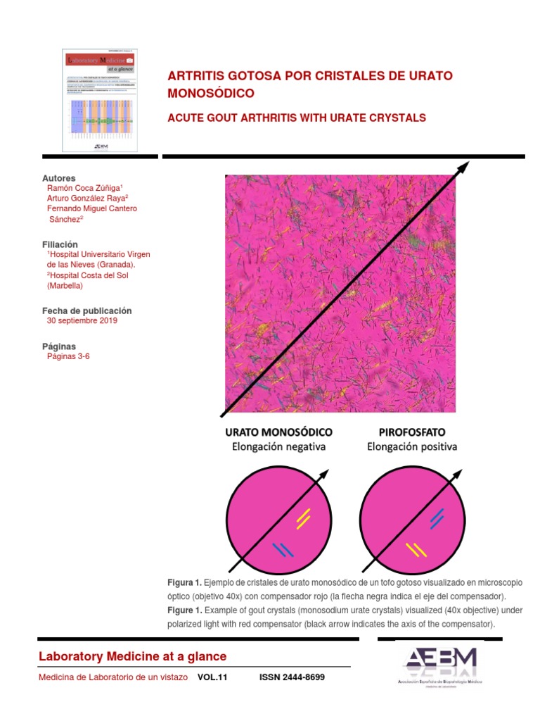 Cristales de Urato Monosódico en Gota | PDF | Ciencia y matemáticas