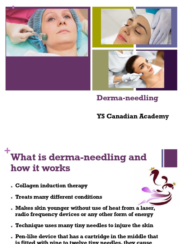 Presentation+Derma Needling+Power+Point+ 3 | PDF | Skin | Scar