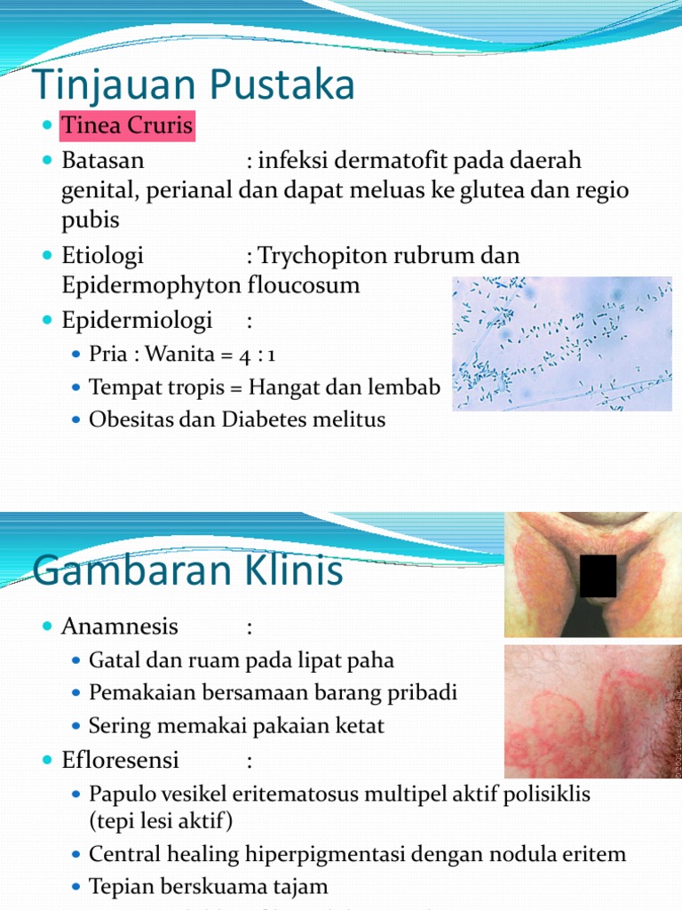 Tinea Cruris | PDF