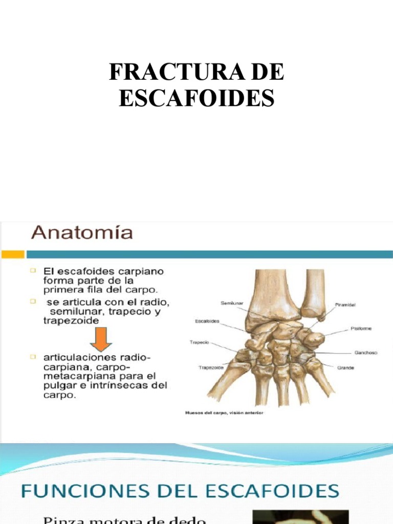 Fractura de Escafoides | PDF