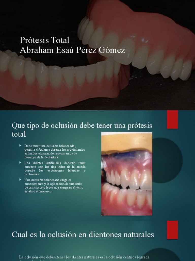 Oclusion en Protesis Total | PDF