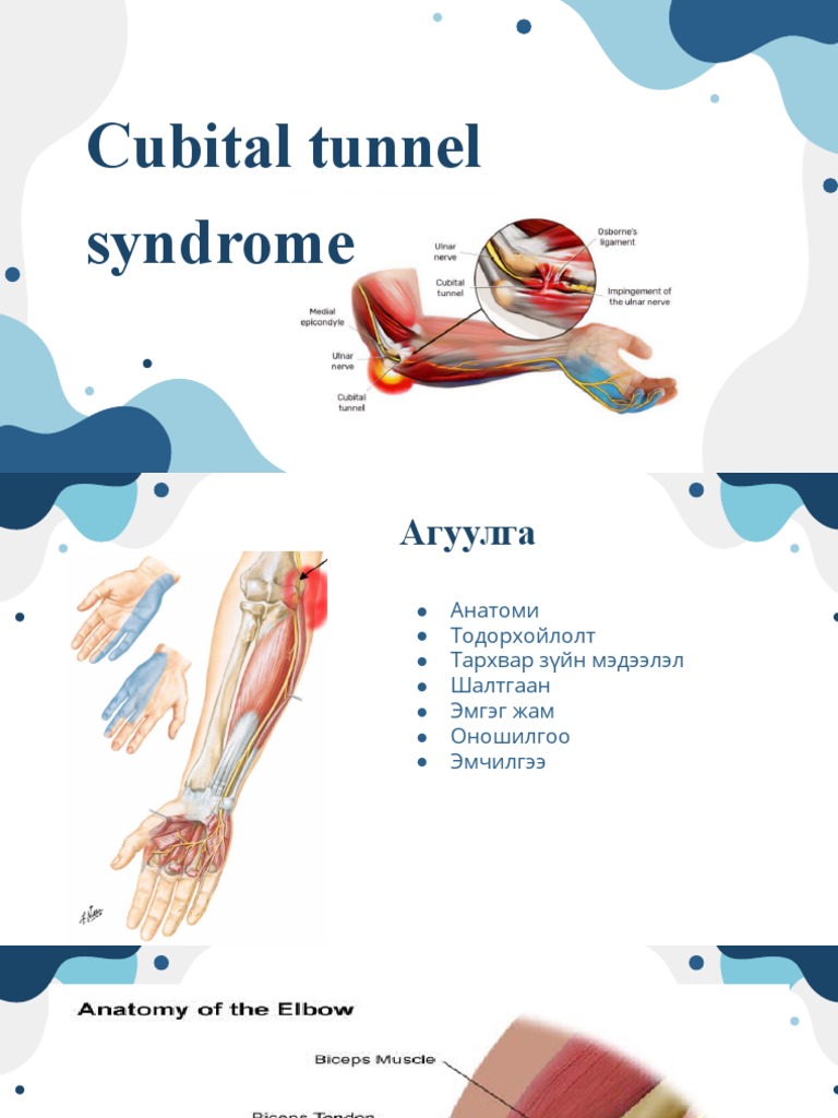 Cubital Tunnel Syndrome | PDF
