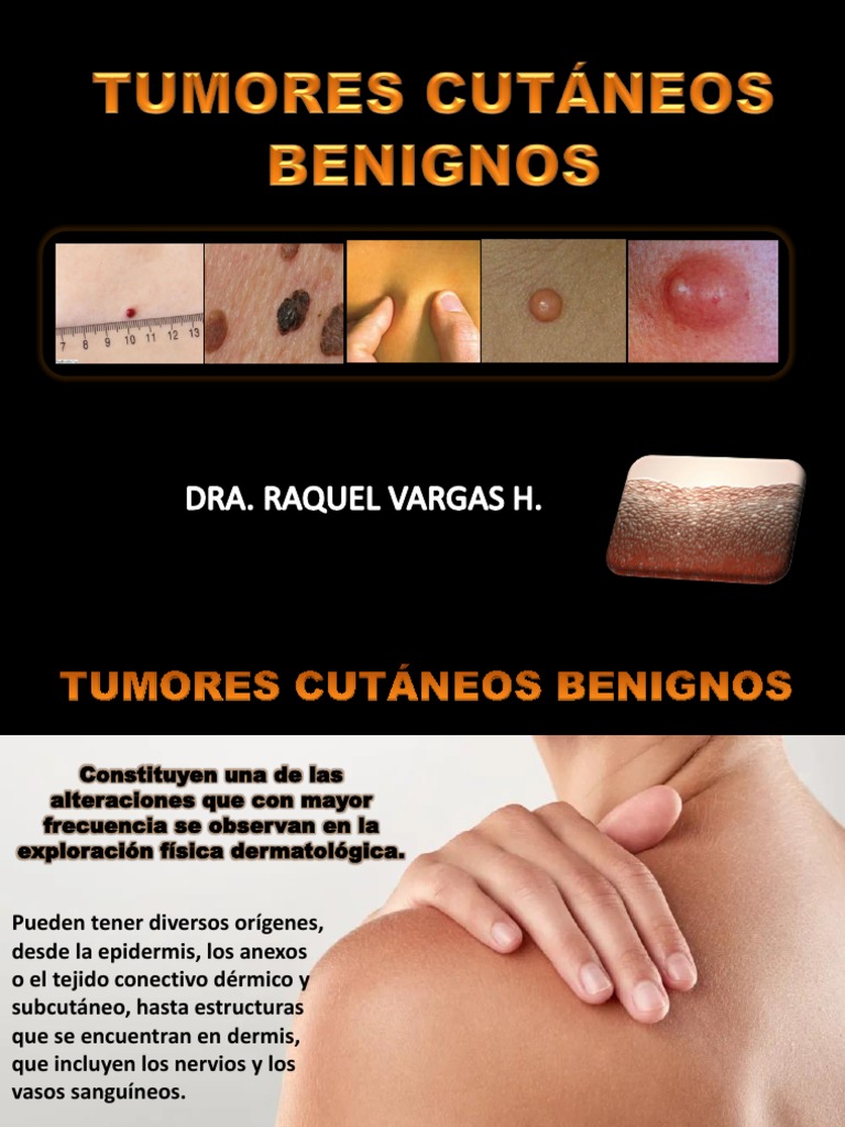 Tumores Cutáneos Benignos | PDF | Piel | Neoplasias