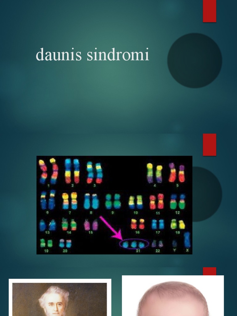 Daunis Sindromi | PDF