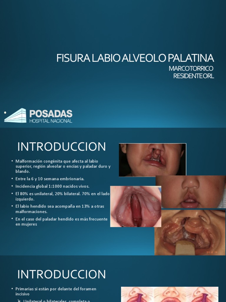 Fisura Labio Alveolo Palatina | PDF | Especialidades Medicas | Medicina ...