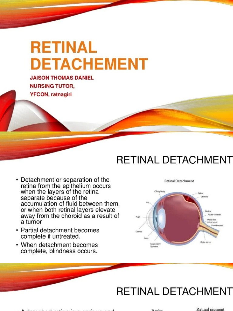 Retinal Detachment | PDF