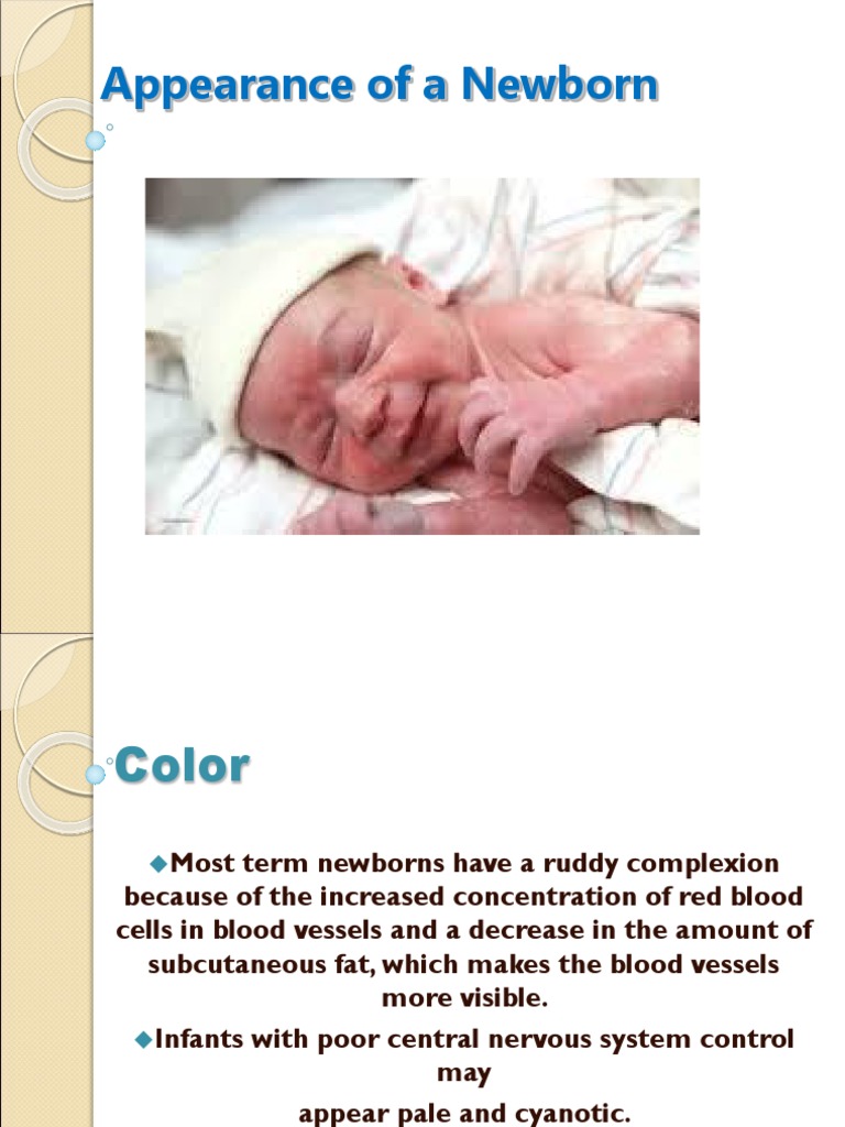 Appearance of A Newborn | Download Free PDF | Clinical Medicine ...