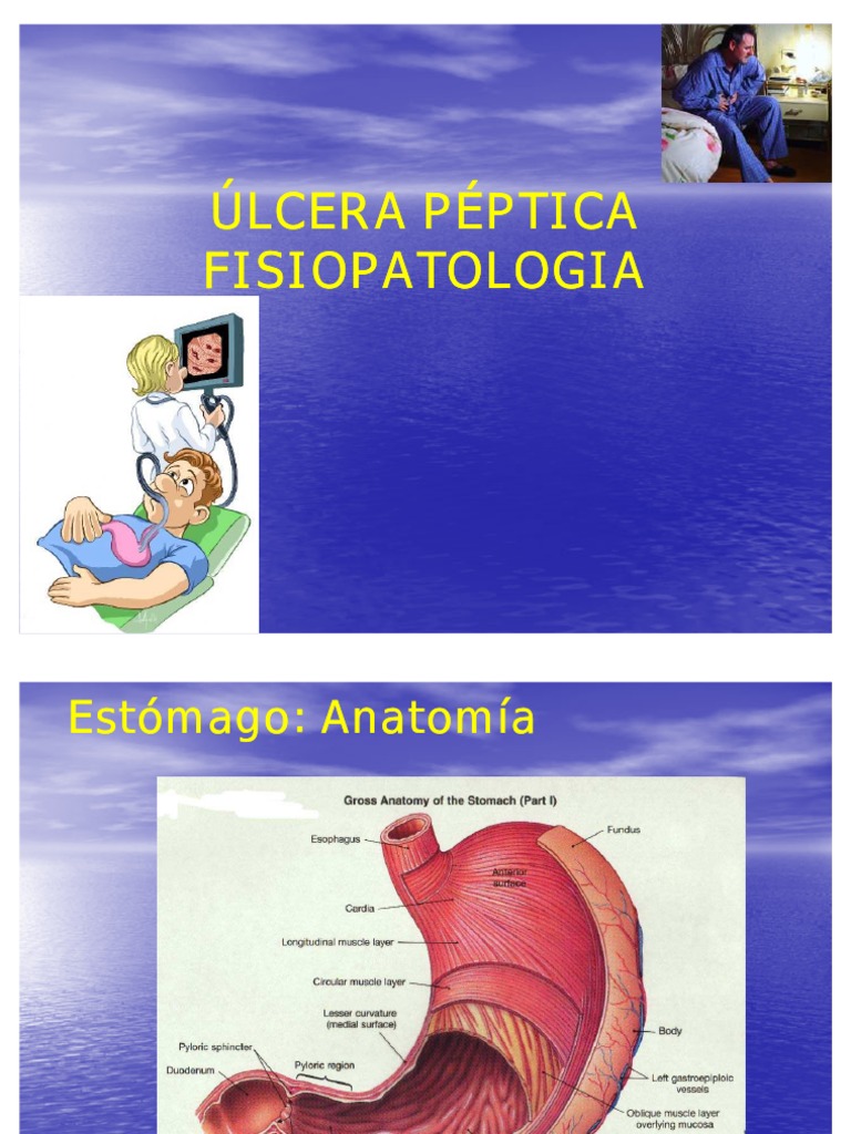 Fisiopatologia Ulcera peptica | Úlcera péptica | Estómago