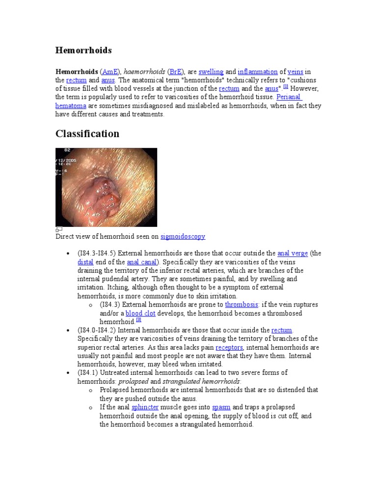 Hemorrhoids | Hemorrhoid | Constipation
