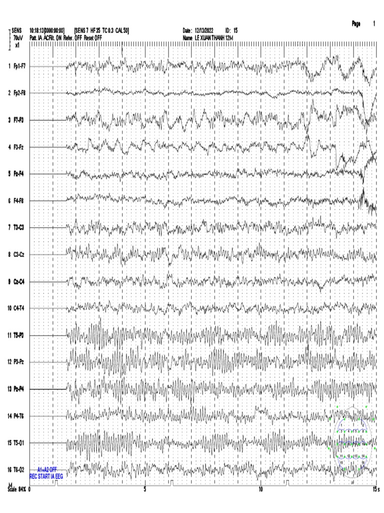 Eeg Review | PDF Eeg Review | PDF