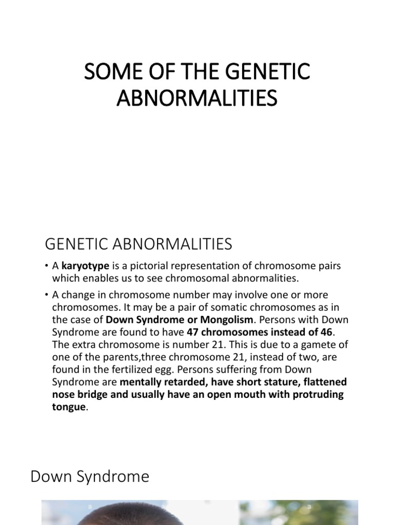 Major Genetic Abnormalities: Down Syndrome, Turner Syndrome ...