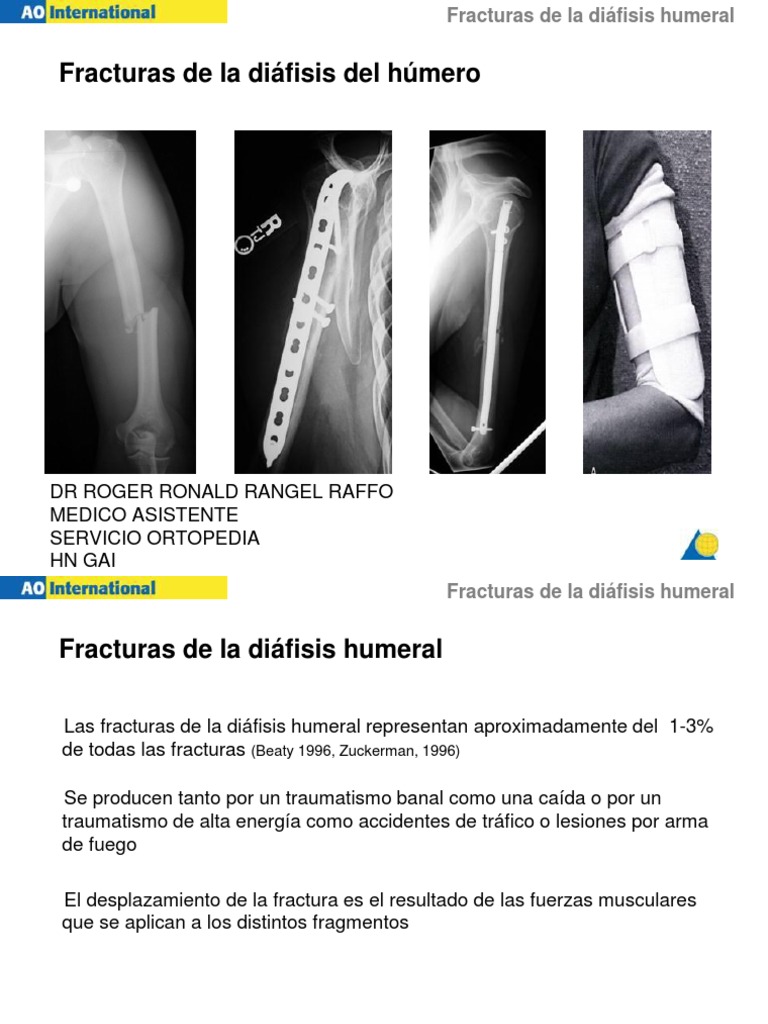 Fractura de Húmero | PDF | Sistema musculoesquelético | Anatomía