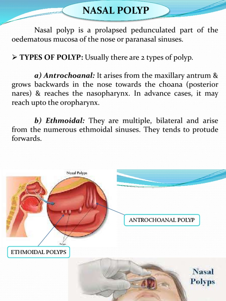 Nasal Polyp | PDF | Human Nose | Human Head And Neck