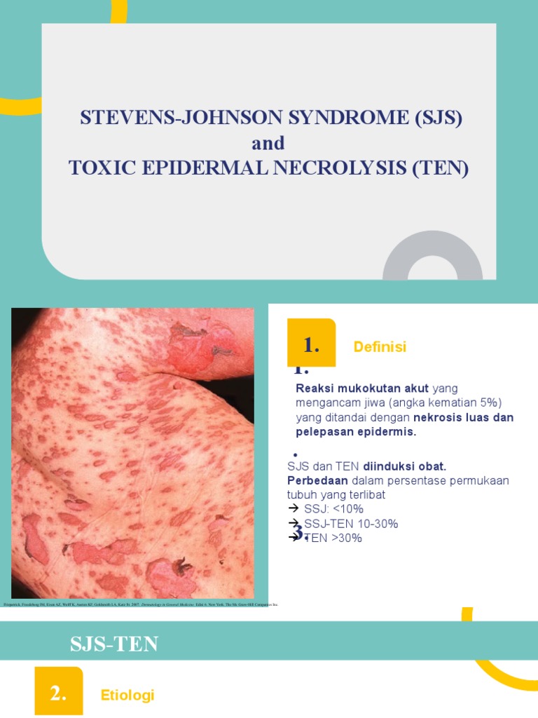Pemahaman Sindrom Stevens-Johnson | PDF