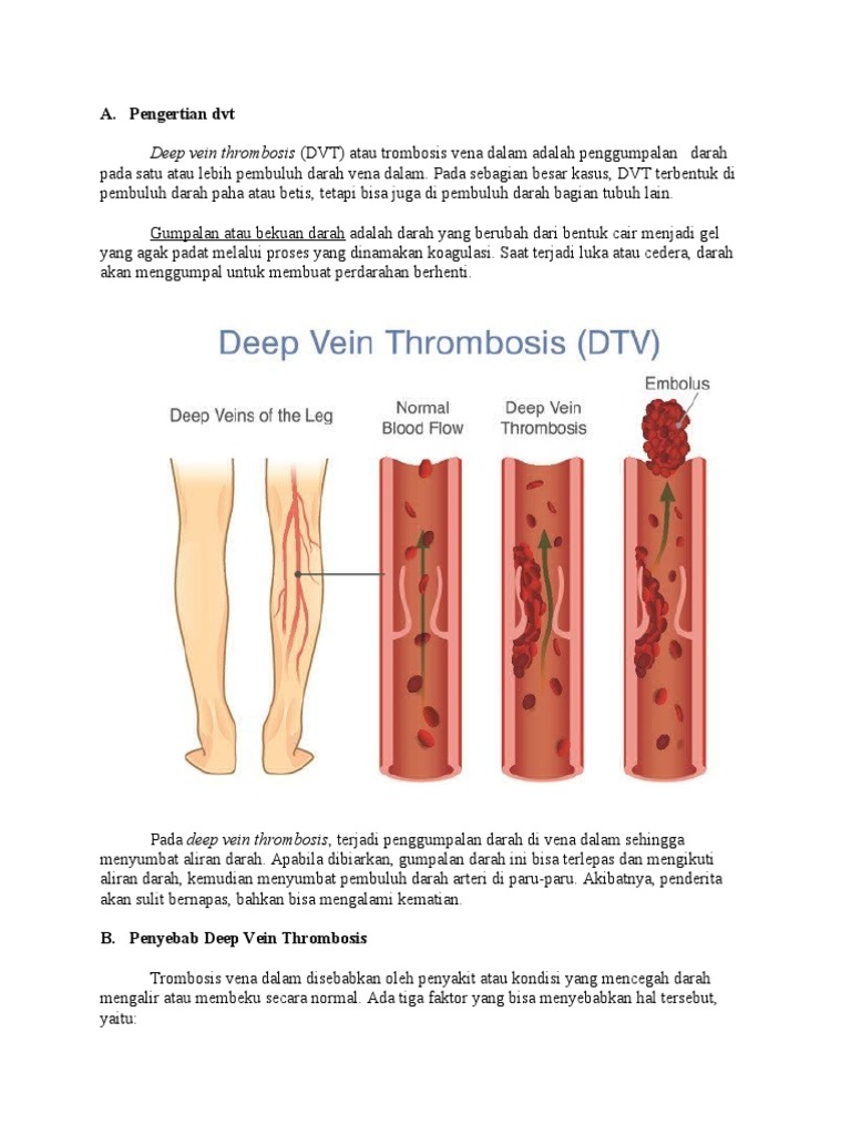 Pengertian, Penyebab, Gejala, dan Pengobatan Deep Vein Thrombosis (DVT) | PDF