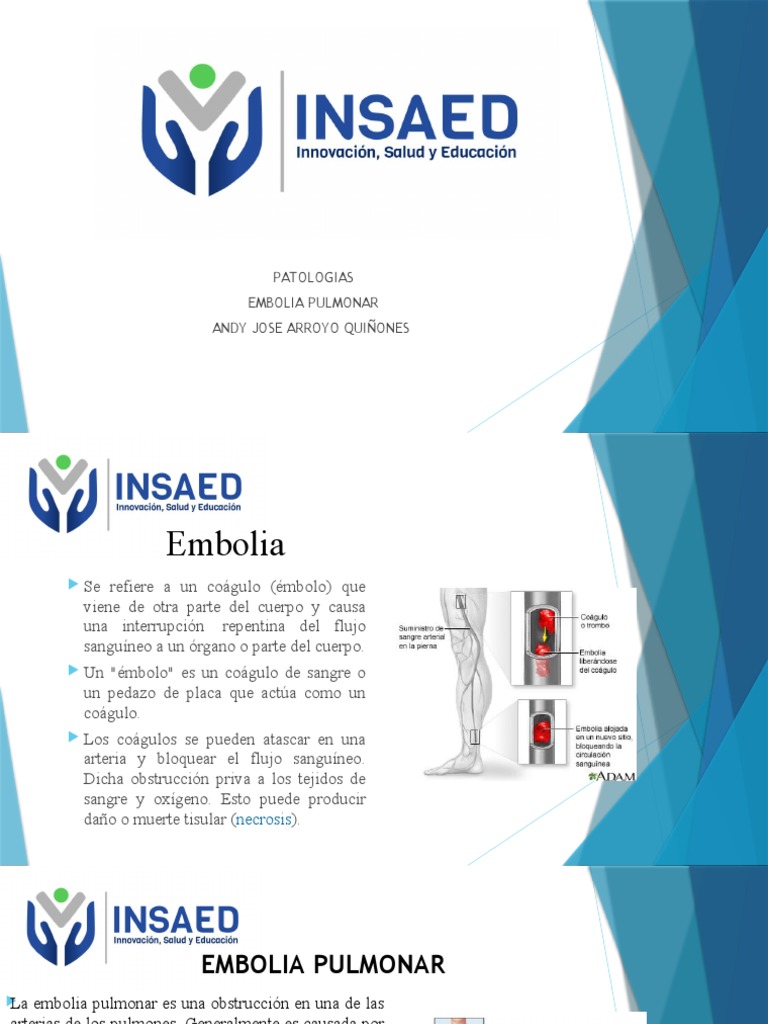 Exposicion Embolia | PDF | Embolia | Trombo
