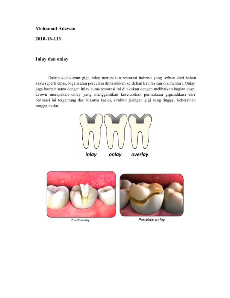 Inlay Dan Onlay | PDF