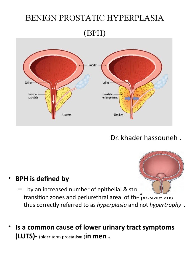 Benign Prostatic Hyperplasia | PDF | Prostate | Urinary Incontinence