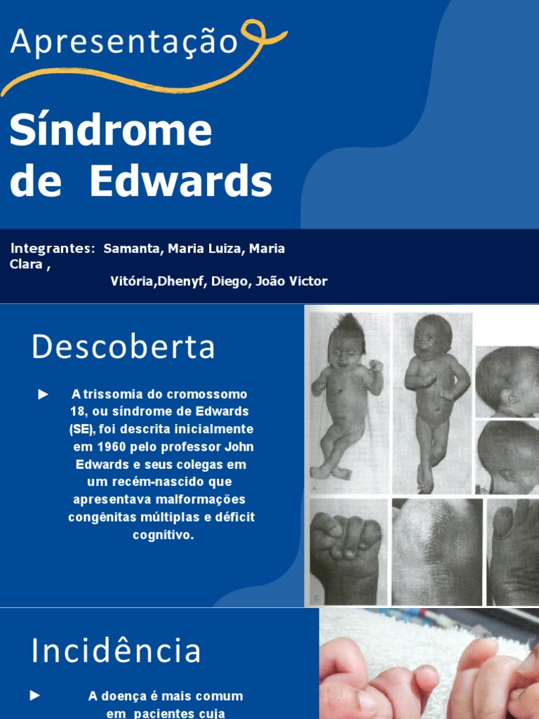 Síndrome de Edwards: Características e Prognóstico | PDF