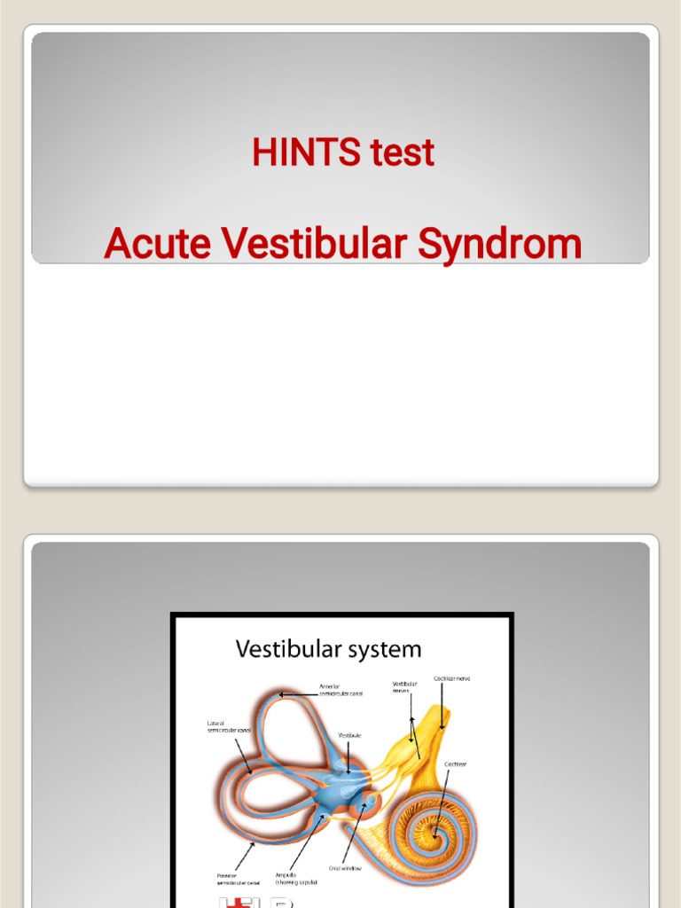HINT | PDF | Vestibular System | Vertigo