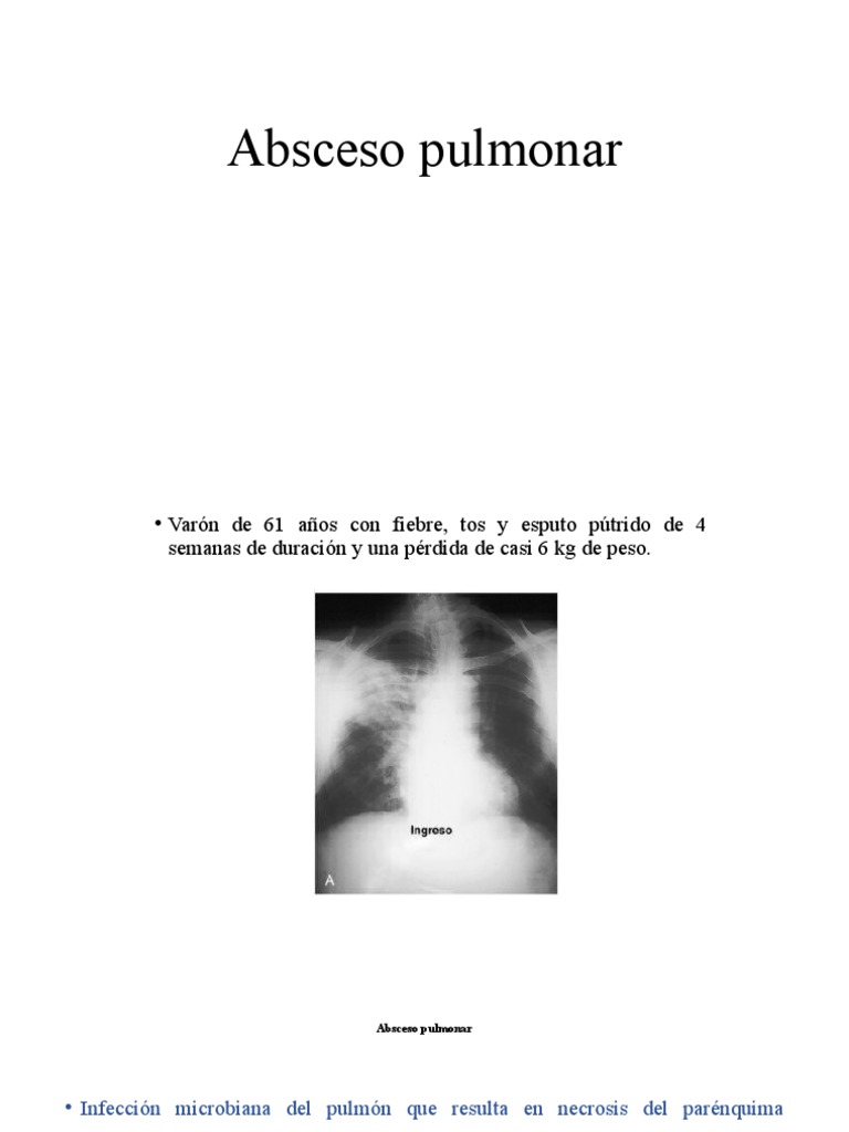 Absceso Pulmón | PDF | Tos | Causas de la muerte
