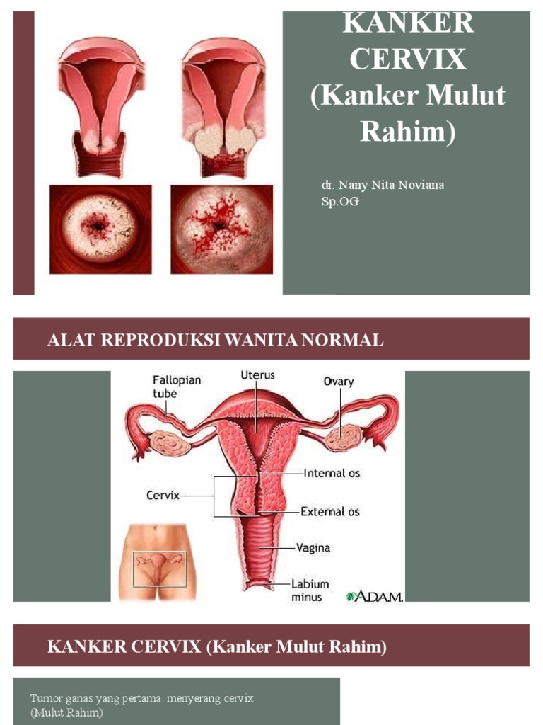 Materi Ca Cervix | PDF