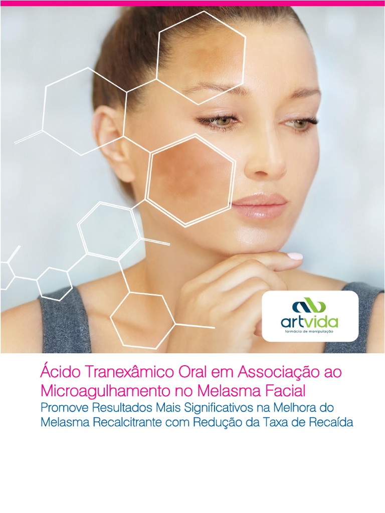 Ácido Tranexâmico Oral em Associação Ao Microagulhamento No Melasma ... Ácido Tranexâmico Oral em Associação Ao Microagulhamento No Melasma ...