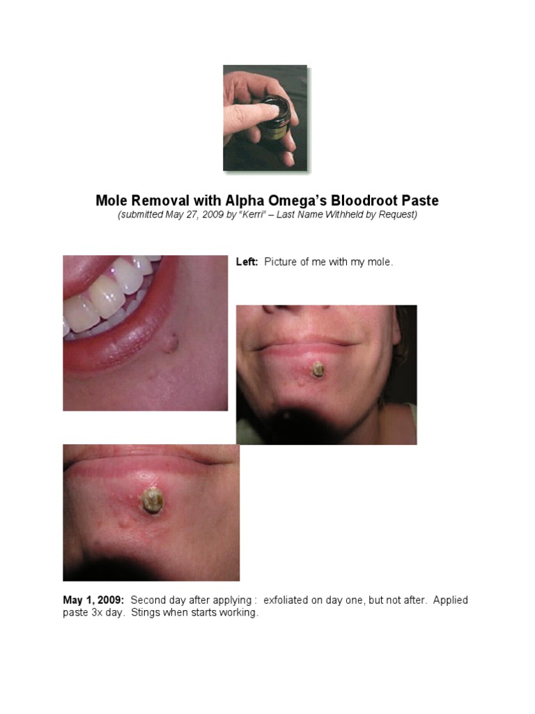 Alpha Blood Root Paste Results | PDF | Causes Of Death | Diseases And ...