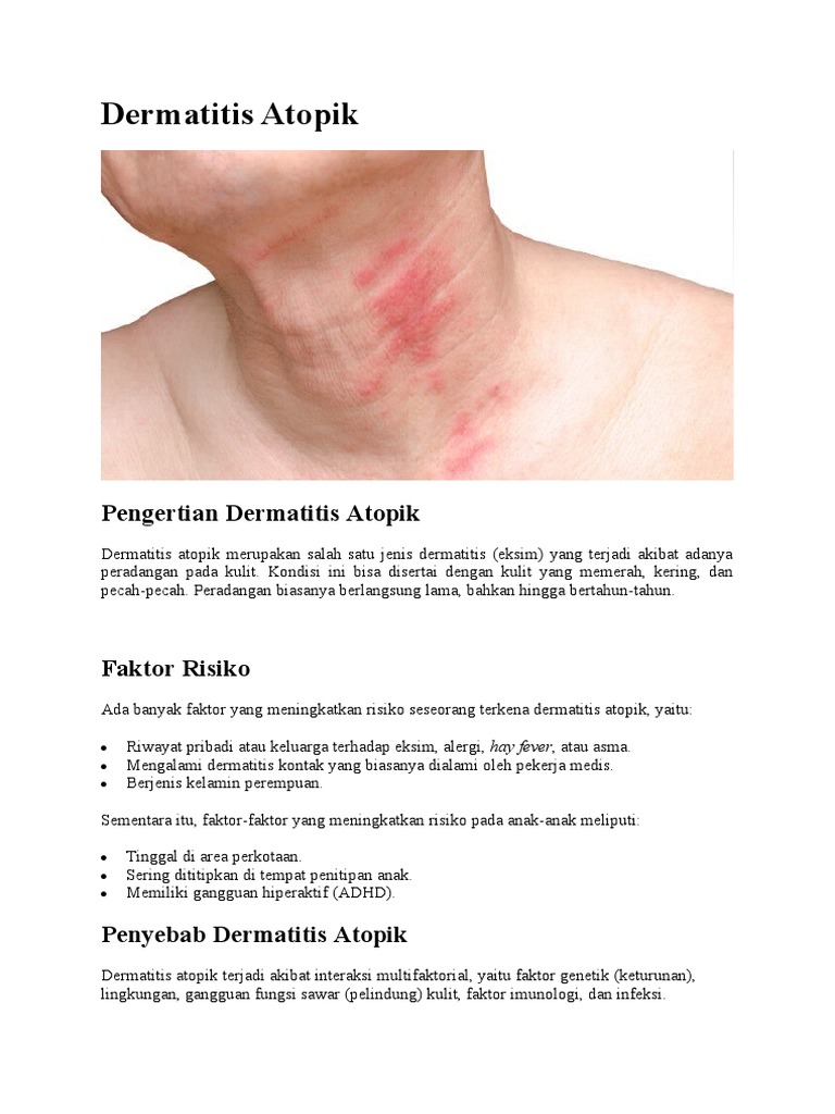 Dermatitis Atopik | PDF