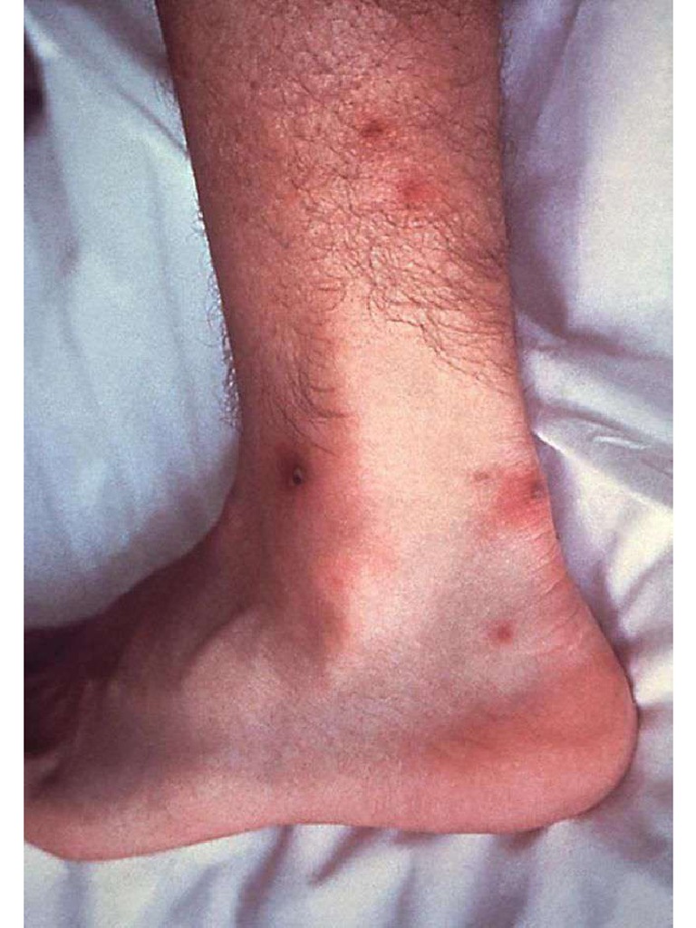 Disseminated Gonococcal Infection Skin Lesions High | PDF