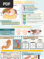 Gastrectomía Parcial | PDF | Estómago | Abdomen