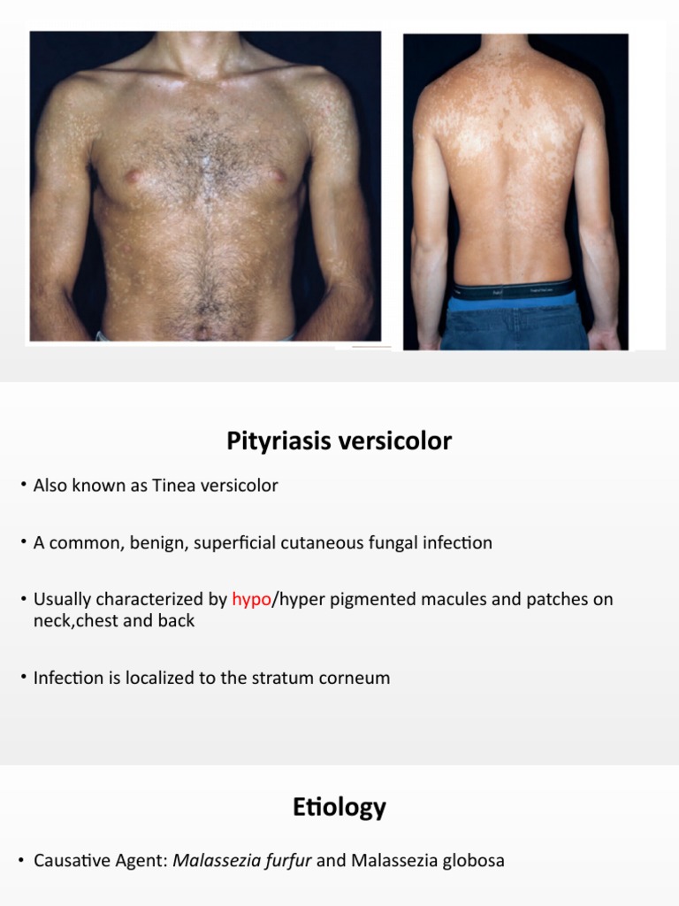 Pityriasis Versicolor Overview and Treatment | PDF | Dermatology | Medicine