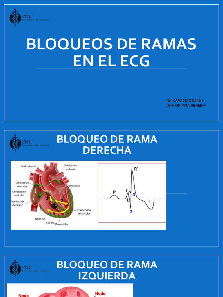 Bloqueos de Ramas en El Ecg | PDF