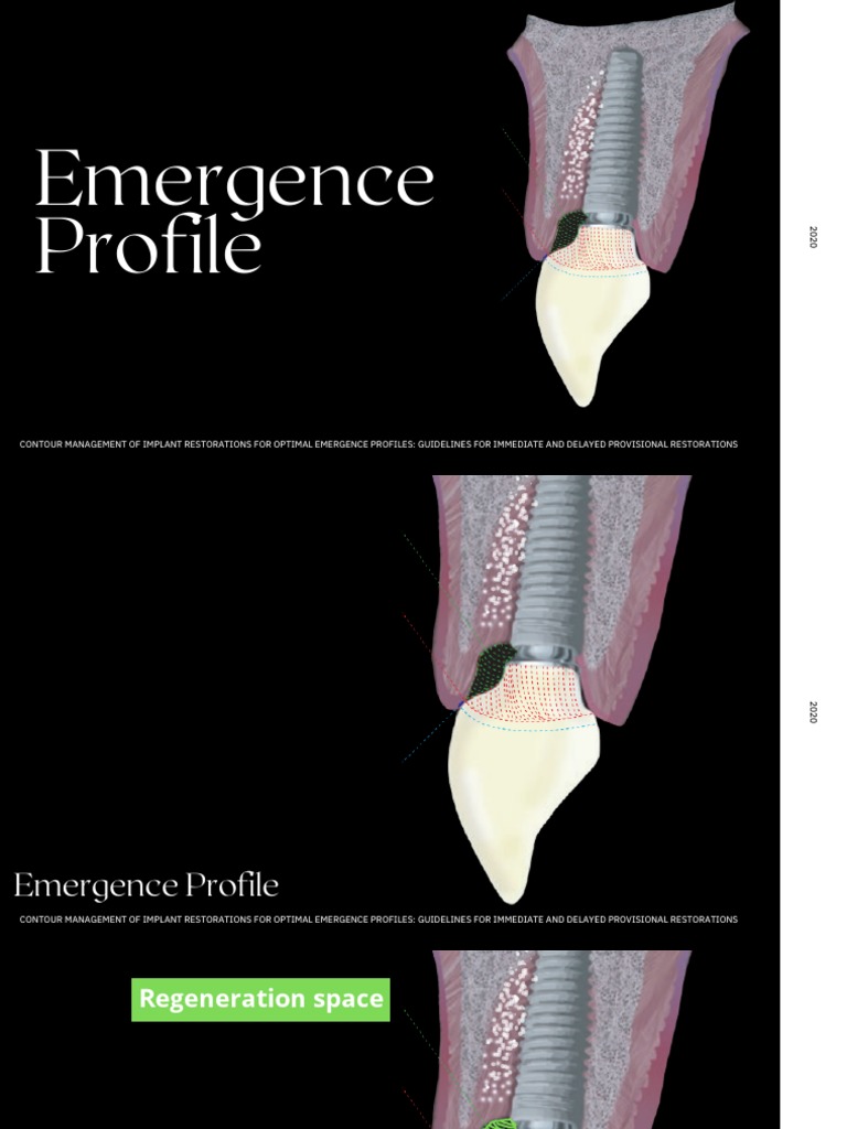 Optimal Emergence Profiles for Implant Restorations | PDF | Clinical ...