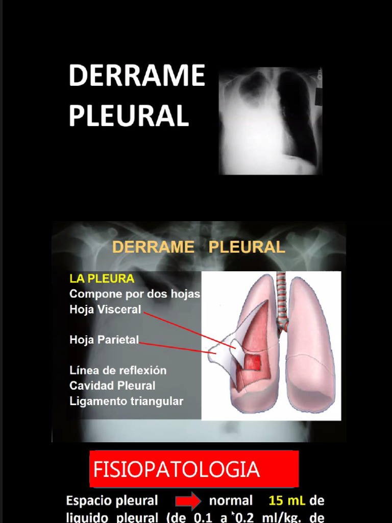 Derrame Pleural | PDF