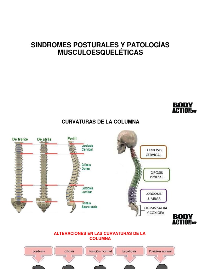 Sindromes Posturales | PDF | Dolor lumbar | La columna vertebral