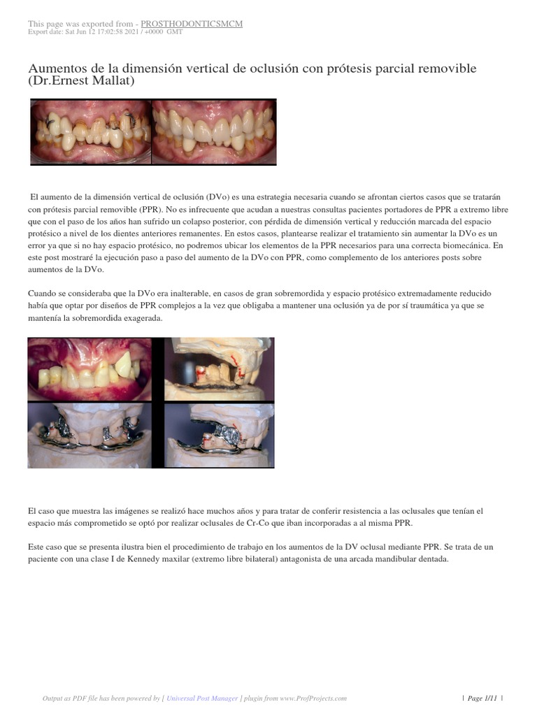 Aumentos de La Dimensión Vertical de Oclusión Con Prótesis Parcial ...