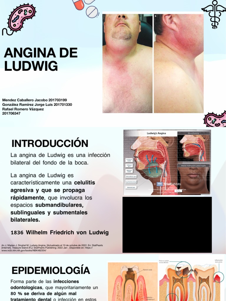 35 Angina de Ludwig | PDF | Especialidades Medicas | Enfermedades y ...