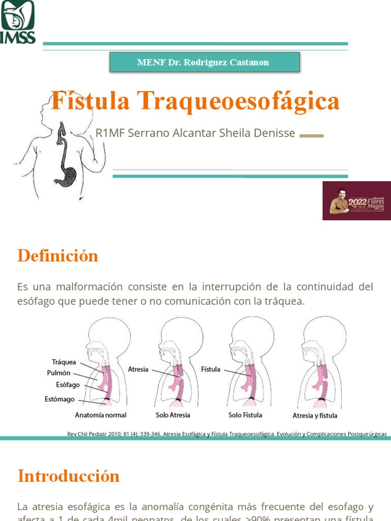 Fístula Traqueoesofagica | PDF