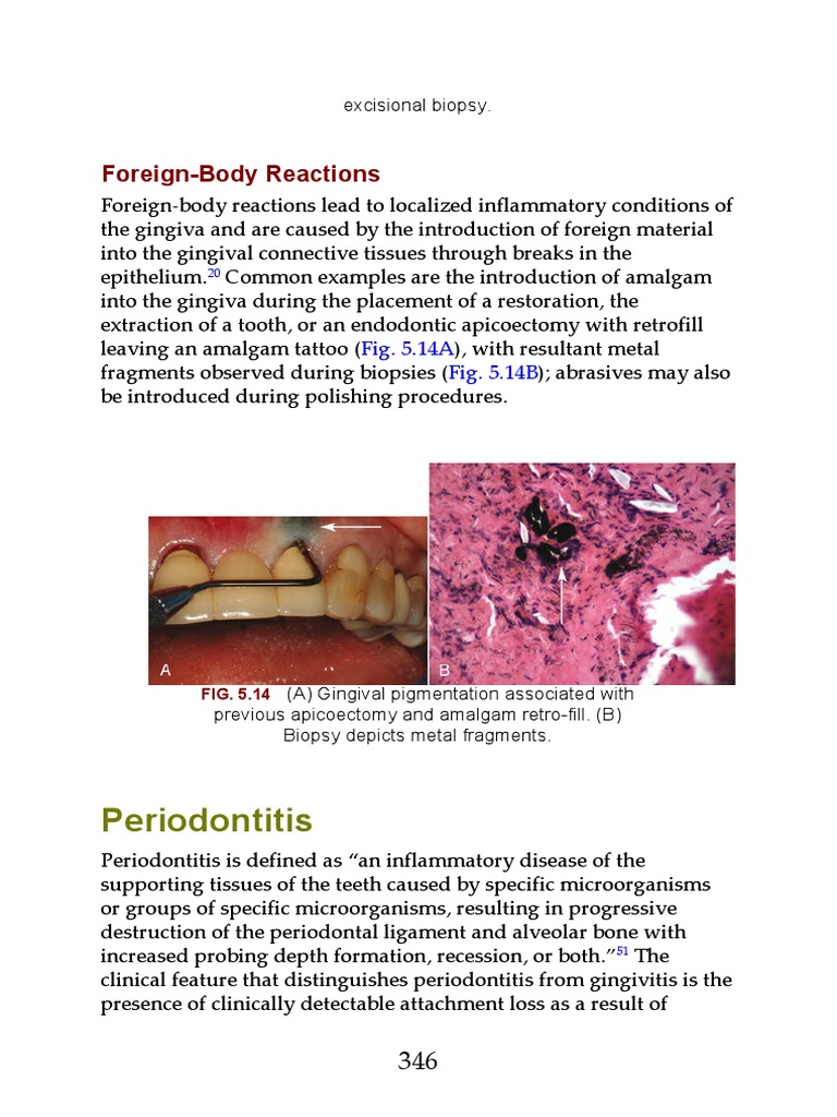 Periodontitis: Foreign-Body Reactions | PDF | Periodontology | Chronic ...