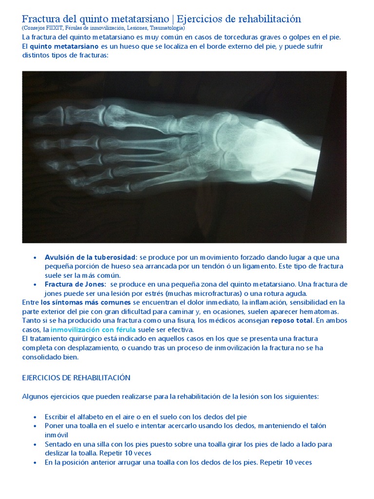 Fractura Quinto Metatarsiano | PDF | Pie | Medicina