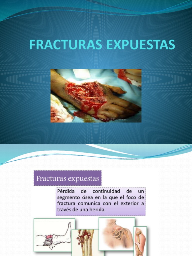 Manejo de Fracturas Expuestas | PDF | Salud y bienestar