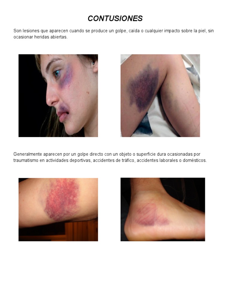 Contusiones, Heridas de Arma de Fuego y Blanca | PDF