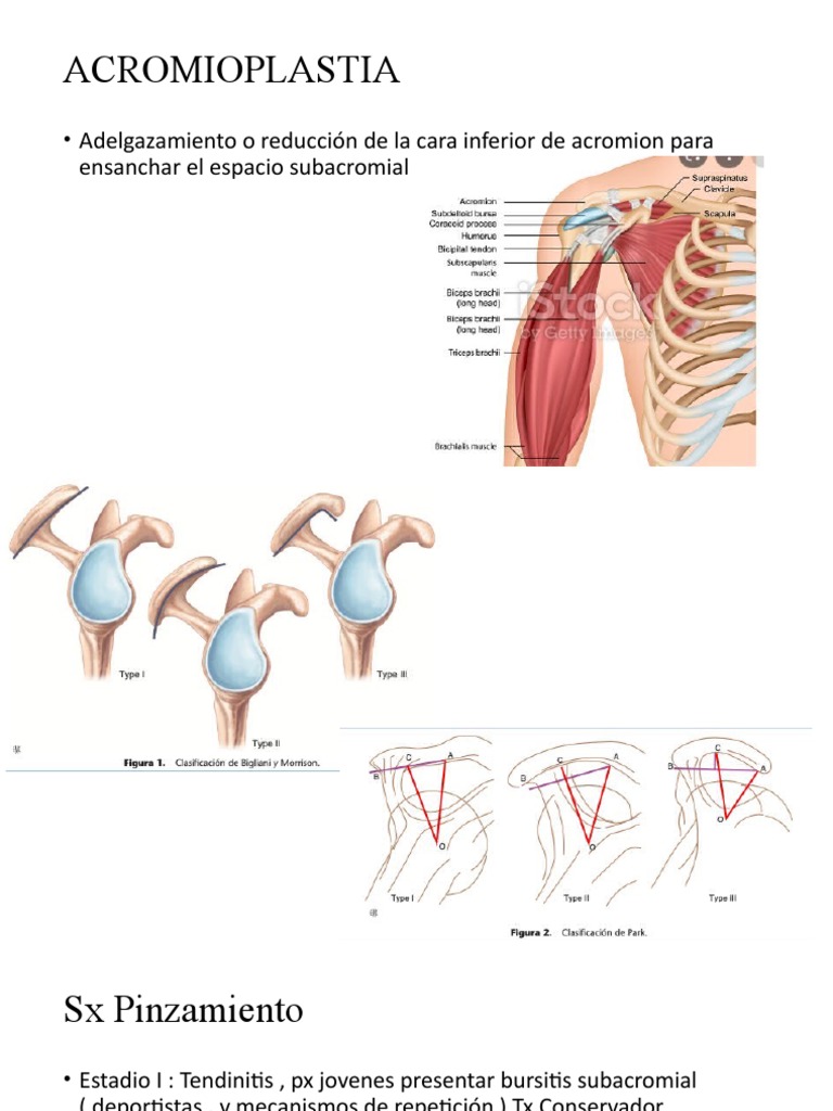 Acromioplastia: Procedimiento y Rehabilitación | PDF | Métodos y ...