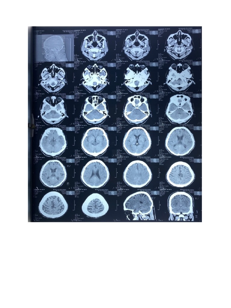 CT Scan Normal | PDF