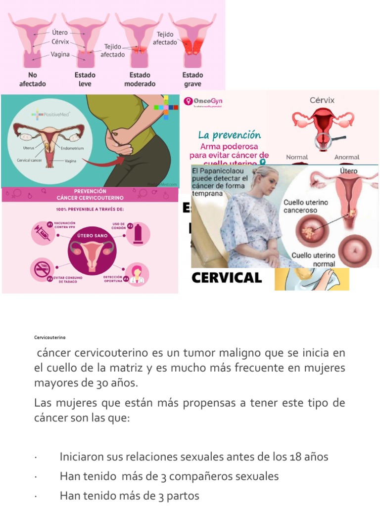 Cancer Cervico | PDF | Cáncer de cuello uterino | Cáncer