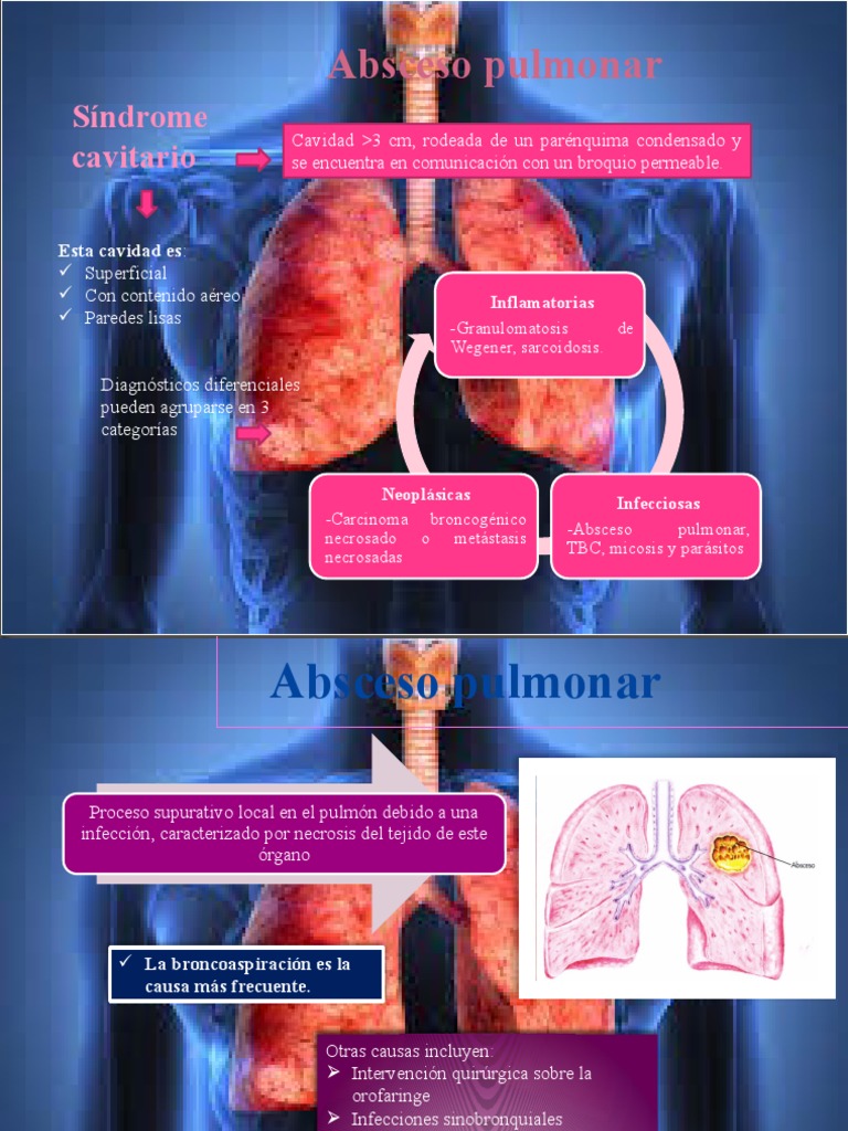 Absceso Pulmonar | PDF | Neumonía | Tos