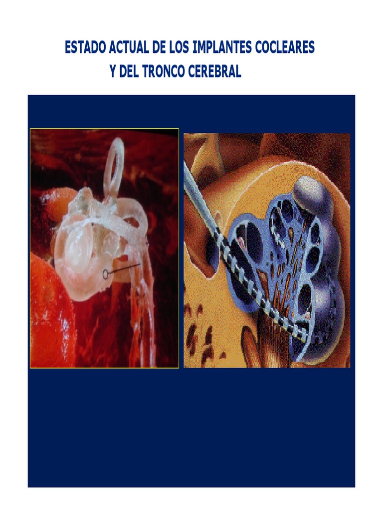 Implante Coclear | PDF | Sonido | Audiología