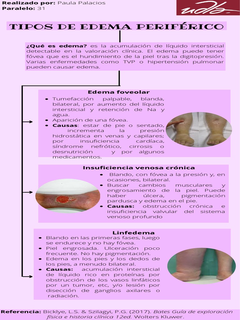Tipos de Edema Periférico | PDF